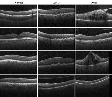 Macula Oct