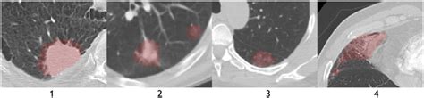 Model Performance On Lidc Dataset Capturing Solid Nodule 1 2