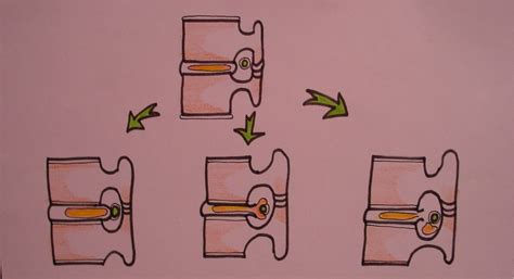 Lumbar Prolapsed Intervertebral Disc A Treatment Algorithm Journal
