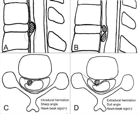 A For An Intradural Extra Arachnoid Disc Herniation The Dura And Download Scientific Diagram