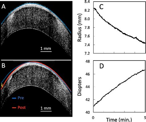 Sd Oct Cross Section View Of Cornea A Pre And B Post Treatment Download Scientific Diagram