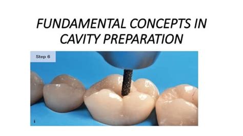 Class Ii Cavity Preparation Pptx Dental Health Diseases And