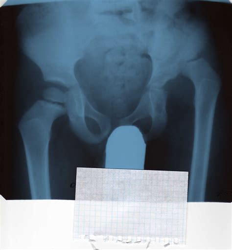 Вывих Тазобедренного Сустава У Детей Фото — Фото Картинки