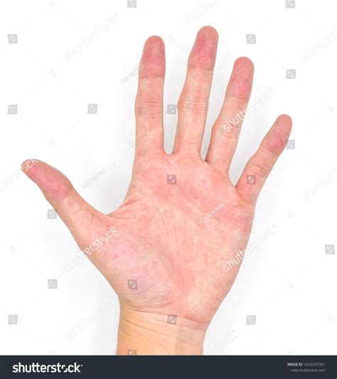 Erythema Hands