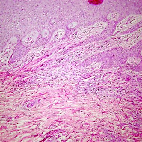 Pustular Pyoderma Gangrenosum Like Ulceration On The Abdomen Of