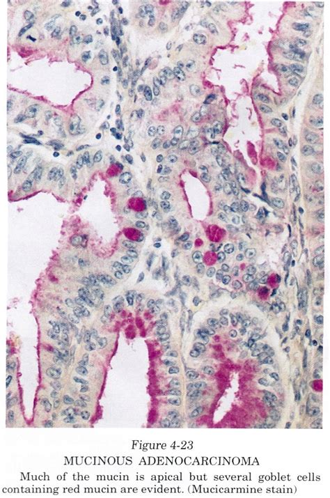 Pathology Outlines Mucinous Carcinoma