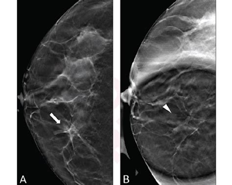 Photo Gallery What Does Breast Cancer Look Like On Mammography