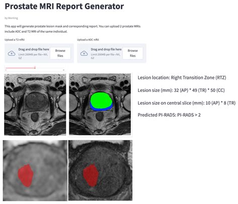 joint cancer segmentation and pi rads classification on multiparametric