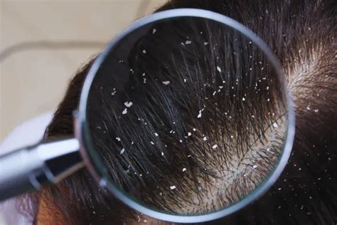 How To Manage Flaky Scalp Causes Treatment And Expert Tips