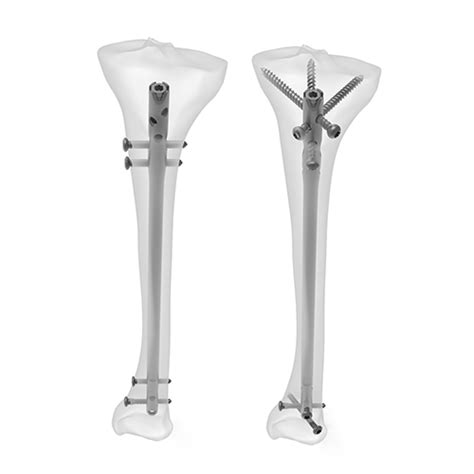 Interlocking Tibia Intramedullary Nail Systemprocedure Inature