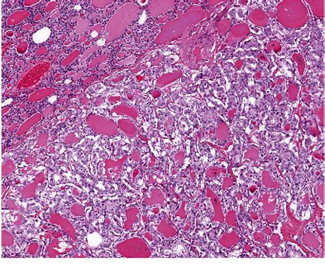 Figure 1 From Noninvasive Follicular Thyroid Neoplasm With Papillary
