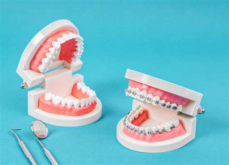 Orthodontic Treatment Options A Guide To The Different Types Of Braces Available