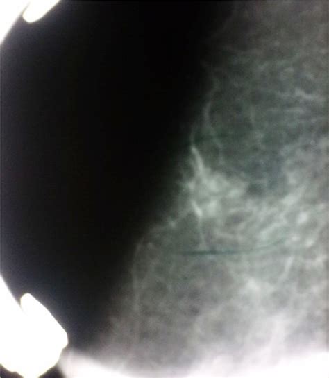 Figure 1 From Combined Imaging Assessment In Radial Scar Of The Breast Semantic Scholar
