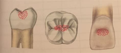 Chapter 19 Restorative Dentisty Flashcards Quizlet