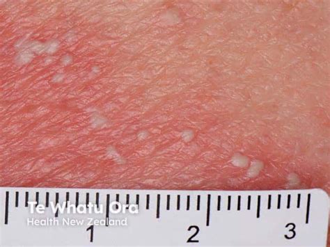 Generalised Pustular Psoriasis Images — Dermnet