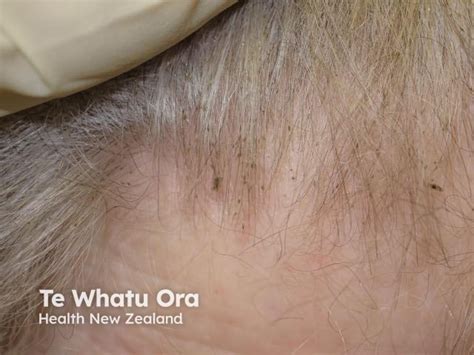 Scalp When Have Lice