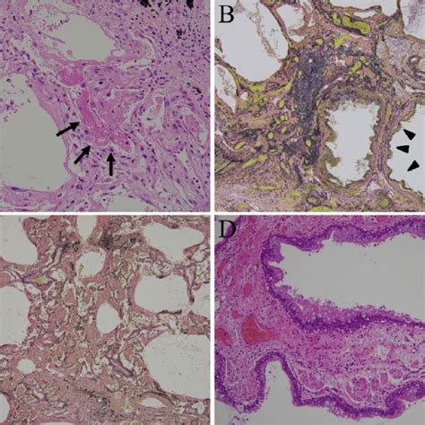 58 Year Old Patient With Cellular Nsip Pattern On Hrct Symmetric