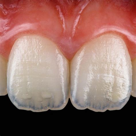 Repairing Relining Rebasing In A Complete Denture Artofit