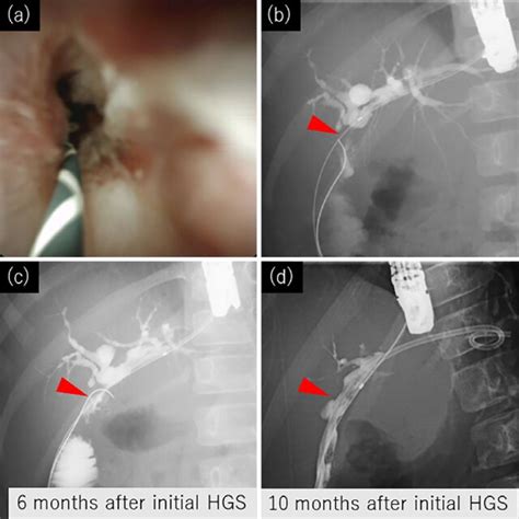 Figure2cholangiogram And X Ray Findings Of The Cjas A Per Oral