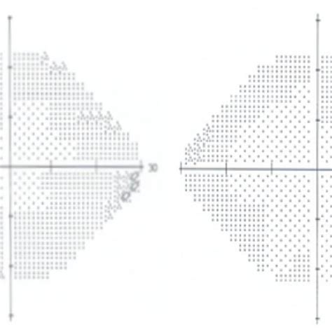 Humphrey Visual Field Testing Shows Enlarged Blind Spots In Both Download Scientific