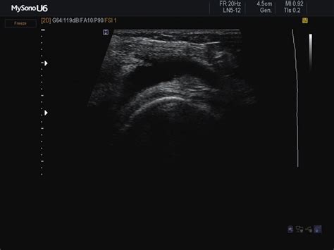 Атлас УЗИ Ревматоидный артрит B режим эхограмма №620