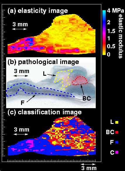 A Shows An Elasticity Image Measured In Vitro And Fig 3 B Shows The Download Scientific