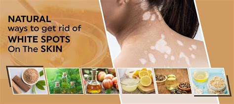 Natural Ways To Get Rid Of White Spots On Skin Medplusmart