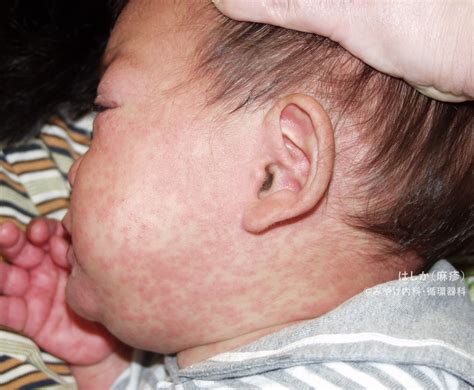 はしか（麻疹）の詳しい説明と写真 ｜ 写真で見る「子どもの病気」 みやけ内科・循環器科【総合内科のアプローチ】