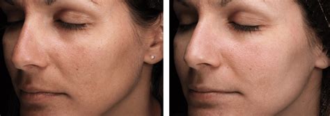 Moxi Laser Treatment Amaira Med Spa Surgical