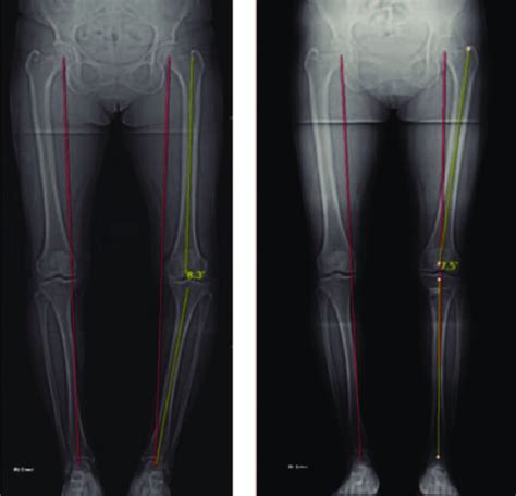 Preoperative And Postoperative Whole Scanogram Download Scientific Diagram