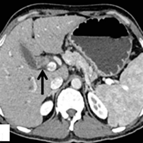 Homogeneously Enhancing Interaortocaval Lymph Node Arrow Download Scientific Diagram