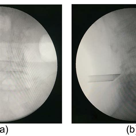 The Localization Of Working Cannula A Bradiography Showing The Download Scientific