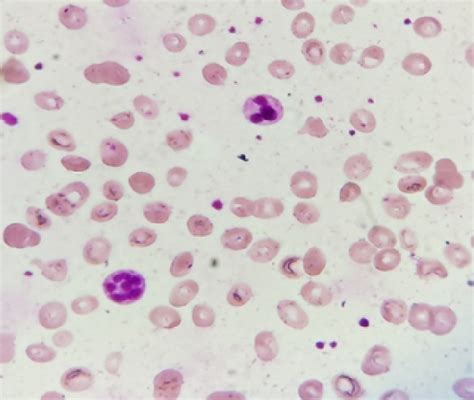 Figure 3 From Platelet Distributionwidth Pdw A Novel Platelet Marker In Thrombocytosis An
