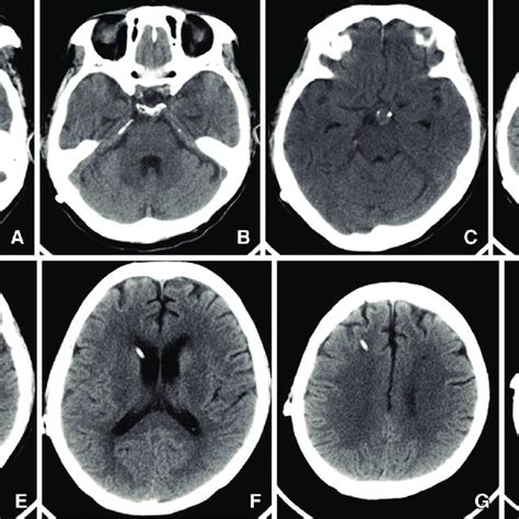A Ct Scan At The Day After Embolization Of Case 2 Showing One White Download Scientific