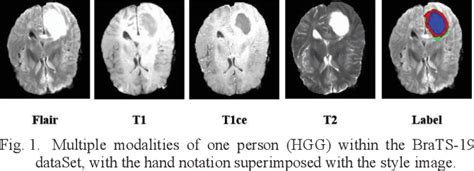 Figure 1 From Brain Tumour Image Segmentation Using Deep Networks