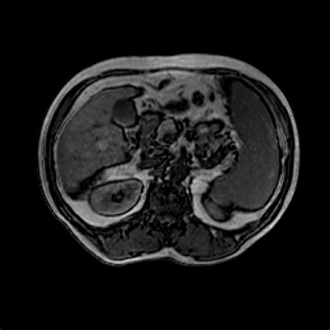 Normal Liver Object Detection Dataset By Akanksha