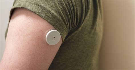 Contact Dermatitis Due To Medical Devices In Diabetic Patients Daily Weby