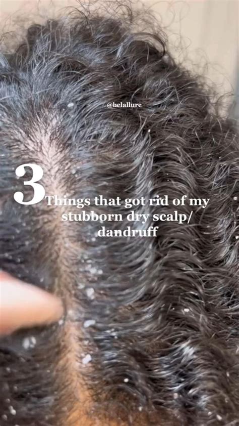 Dry Scalp Dandruff Remedy Diy Hair Treatment Hair Growing Tips Gentle Hair Care