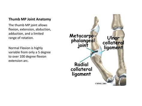 Ppt Innovative Splinting Options For The Thumb Mp Joint Powerpoint