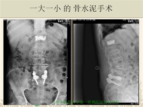 椎体成形中骨水泥充分填充的技巧及意义 好医术早读文章 好医术 赋能医生守护生命