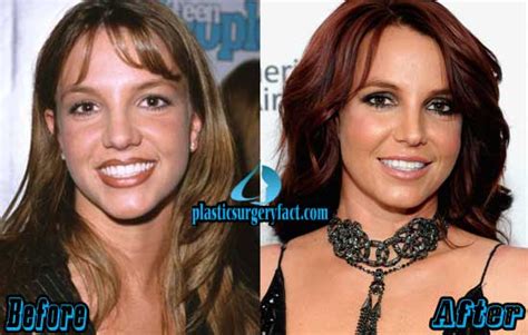 Britney Spears Plastic Surgery Before And After Photos