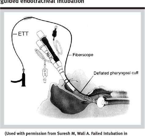 Esophageal Tracheal Tube Vs Endotracheal Tube At Angela Bates Blog