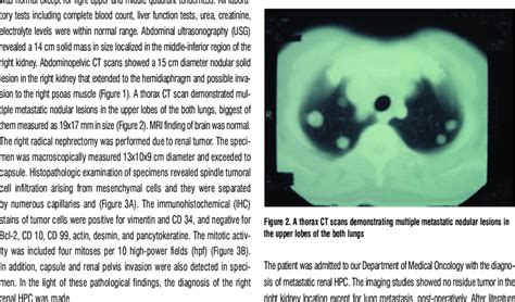 Abdominopelvic Ct Scans Showing A 15 Cm Diameter Nodular Solid Lesion