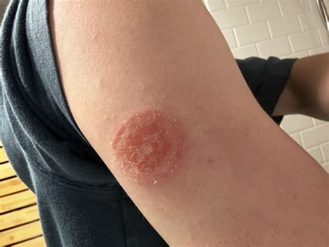 Rashes From G7 Adhesive R Dexcom