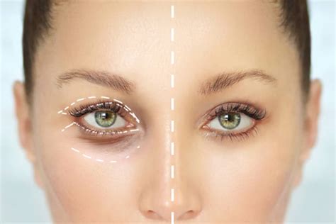 Aftercare For Blepharoplasty Philadephia Dr Kirk Lozada