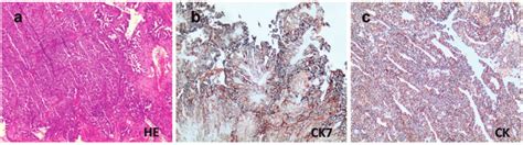 A Histology Shows A Multi Level Papillary Structure With Stratified Download Scientific