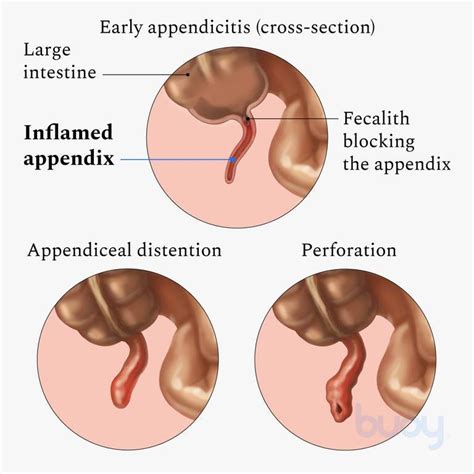 What Are The Procedures For Diagnosis And How Should We Treat Acute Appendicitis By Gitanjali