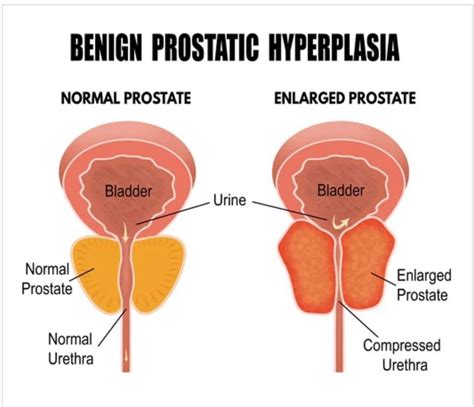 Transurethral Resection Of The Prostate