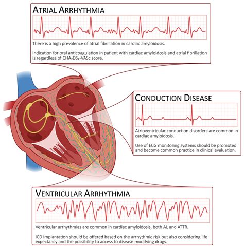 Arrhythmic Định Nghĩa Cách Sử Dụng Và Ví Dụ Minh Họa