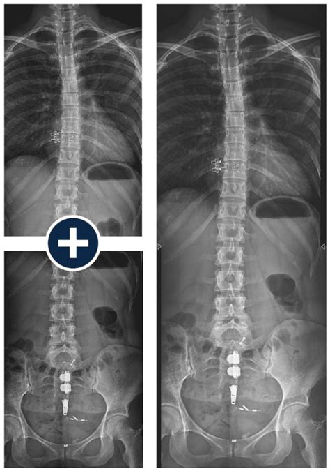 Stitch View X Ray At Dominic Chumleigh Blog